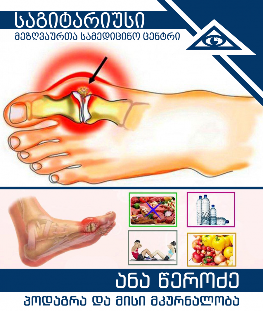 პოდაგრა (ხაფანგი გურმანებისთვის) - SAGITTARIUS Clinic